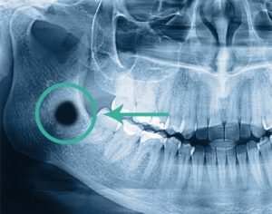Kystes mâchoire Annecy - Stomatotologie - Chirurgie de la bouche