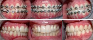 Chirurgie orthognatique / Chirurgie de la machoire Annecy - Maxillo-faciale