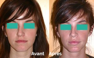 Chirurgie orthognatique / Chirurgie de la machoire Annecy - Maxillo-faciale